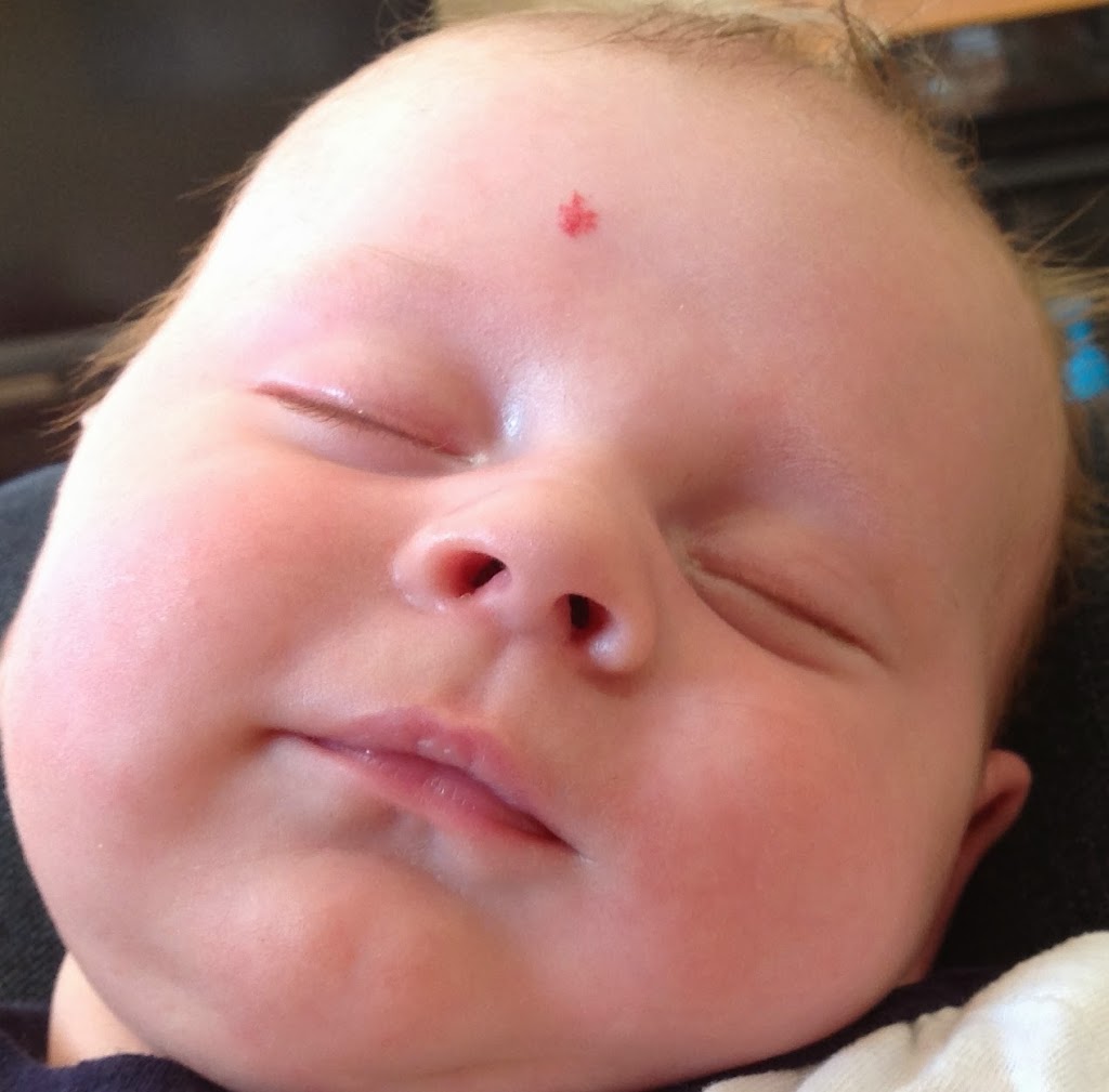 Baby Birthmarks Pictures Photos
